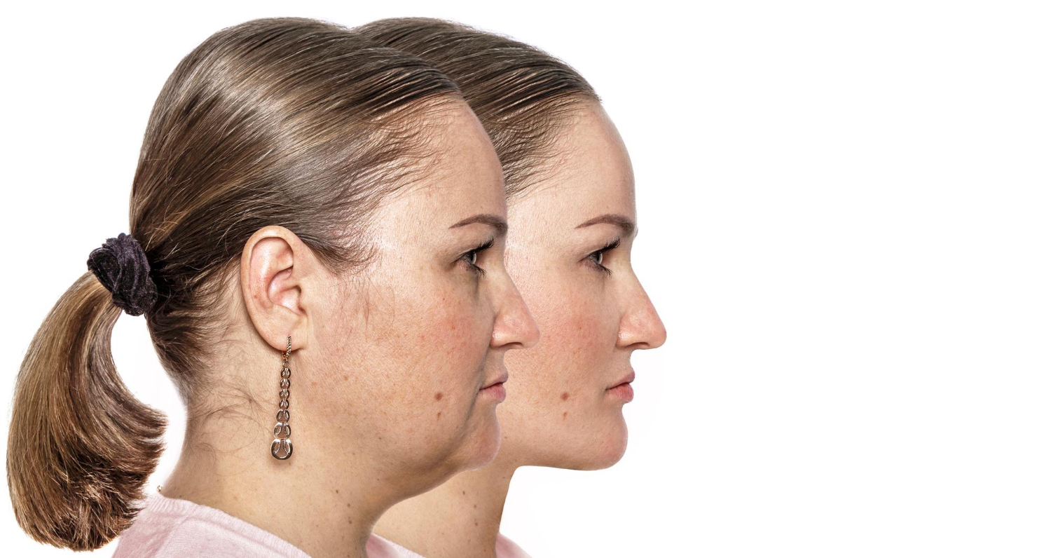 doppelkinn-vor-und-nach-facelift | Beauty Loft Bonn